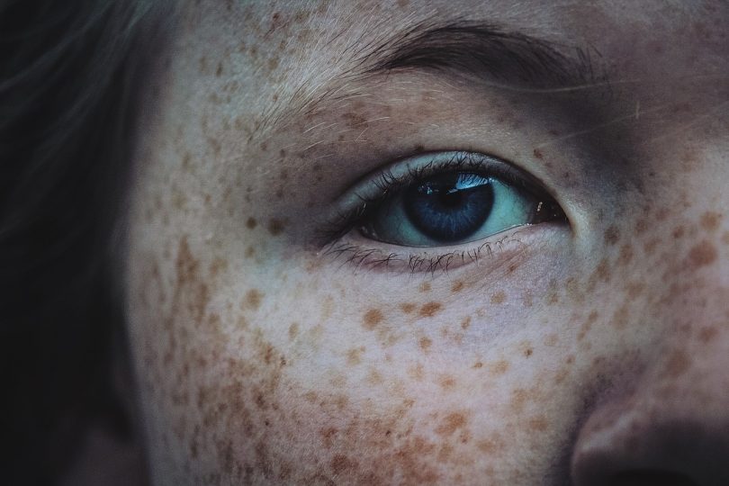 Jak odstranit pihy přírodní cestou - www.Vitalitis.cz